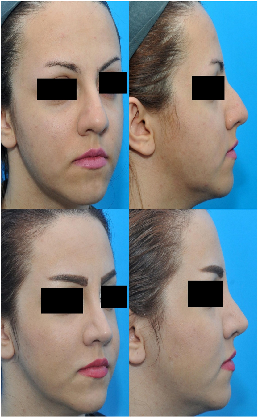 FACIAL IMPLANTS – Fort Hospitals